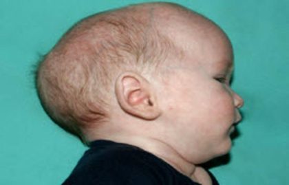 Patient #1584 Craniosynostosis Before and After Photos Montreal, Quebec ...