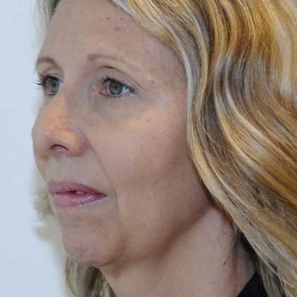 Patient #1609 Fat Injection Before and After Photos Montreal, Quebec ...